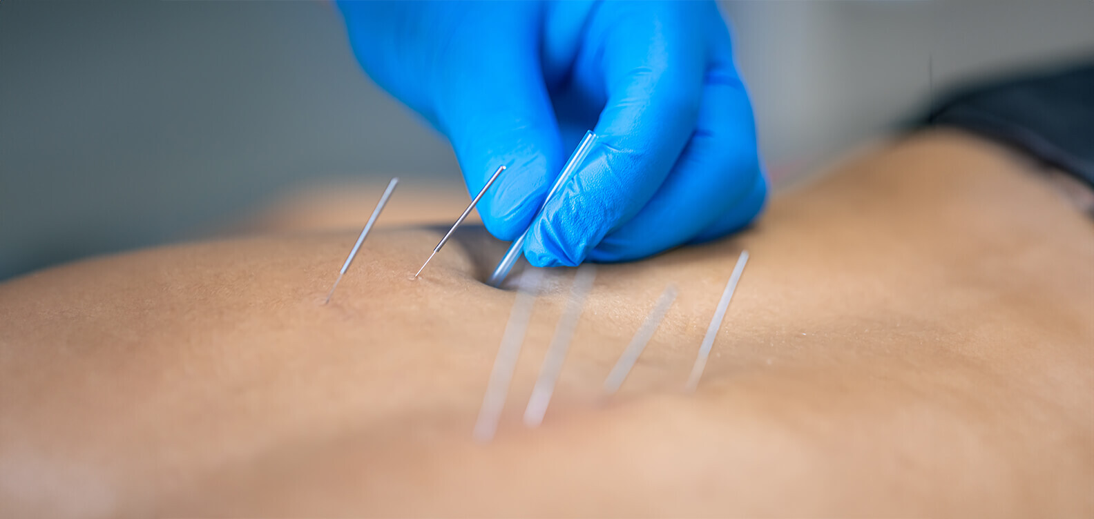 Dry Needle Therapy in Ajman | Valeo Health