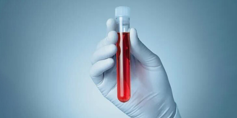 BLOOD TESTS FOR HAIR LOSS – WHAT BIOMARKERS TO LOOK FOR